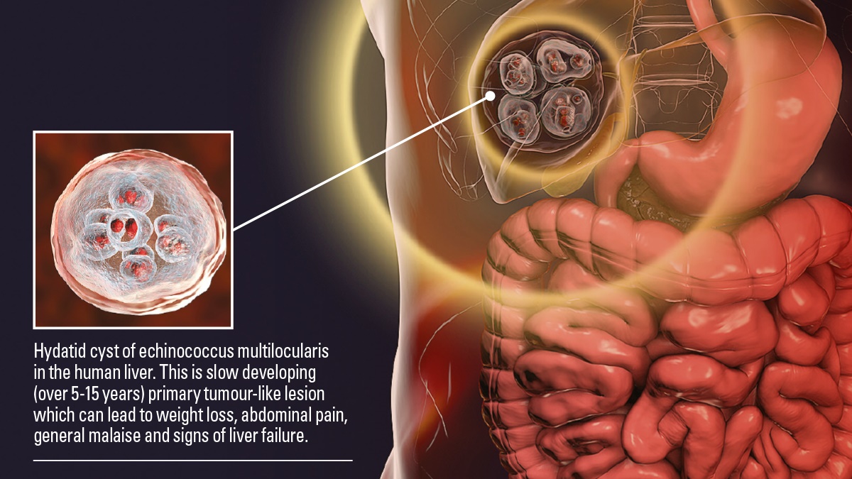 Echinococcus multilocularis: a tiny parasite causing a big problem